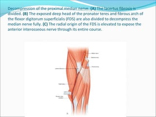 Fibrous Arch Of Flexor Digitorum Superficialis