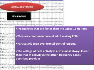 Normal Eeg Tracing