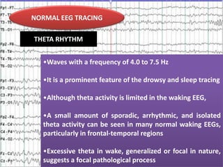 Normal Eeg Tracing