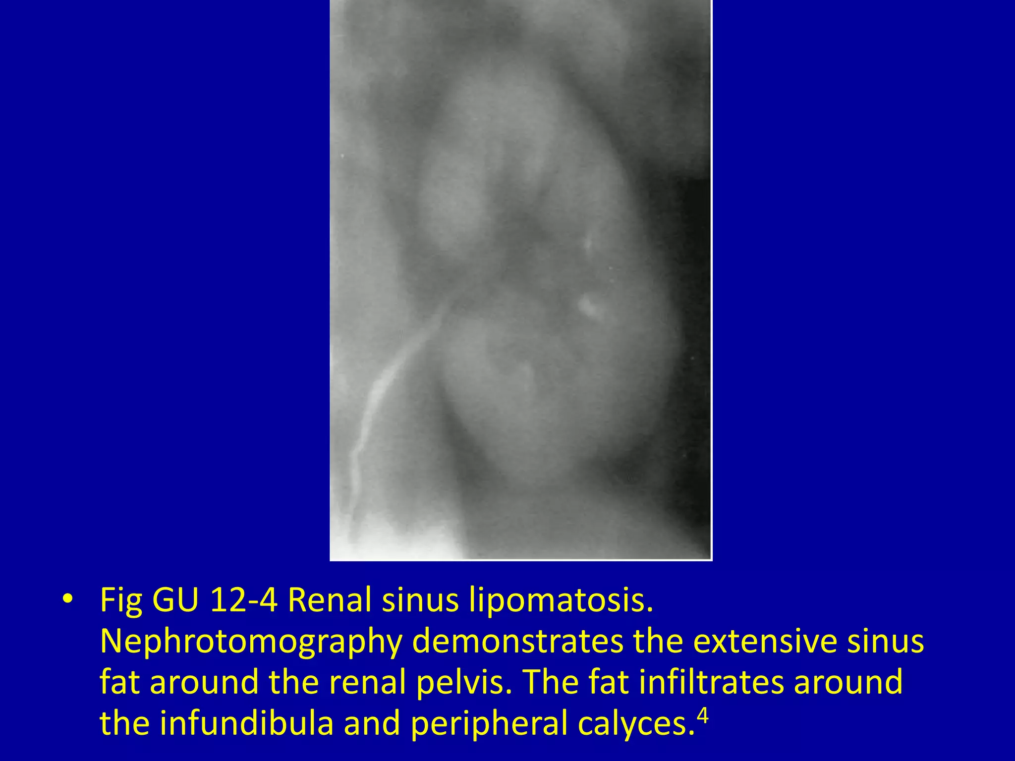 12 renal pseudotumors (normal structures) | PPTX