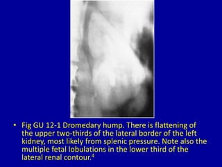 12 renal pseudotumors (normal structures) | PPT