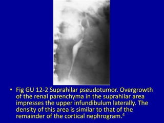 12 renal pseudotumors (normal structures) | PPTX