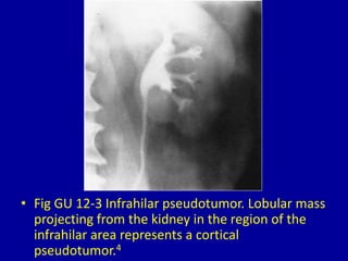 12 renal pseudotumors (normal structures) | PPT