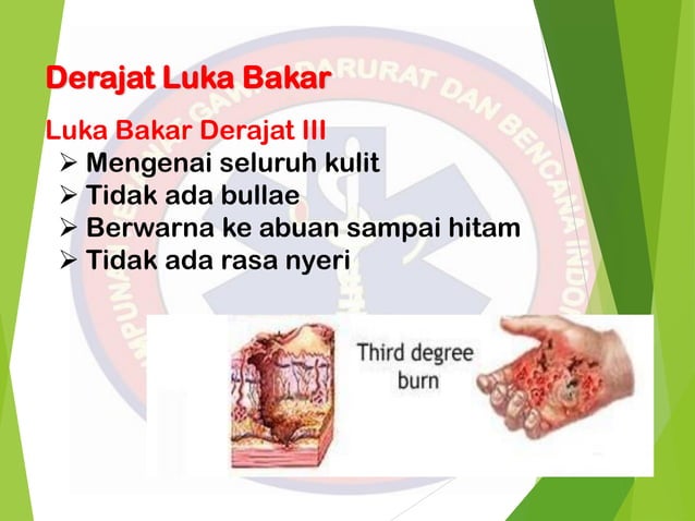 12 Thermal Trauma / Luka Bakar | PPT