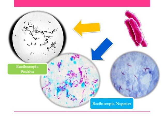 tuberculosis etapas clinicas