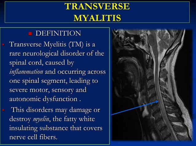 12 Transverse Myelitis.power point prensation | PPT