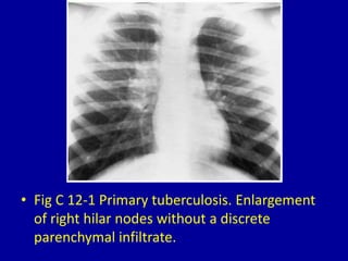 12 unilateral hilar enlargement | PPTX | Lung and Respiratory Health ...