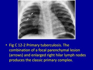 12 unilateral hilar enlargement | PPTX | Lung and Respiratory Health ...