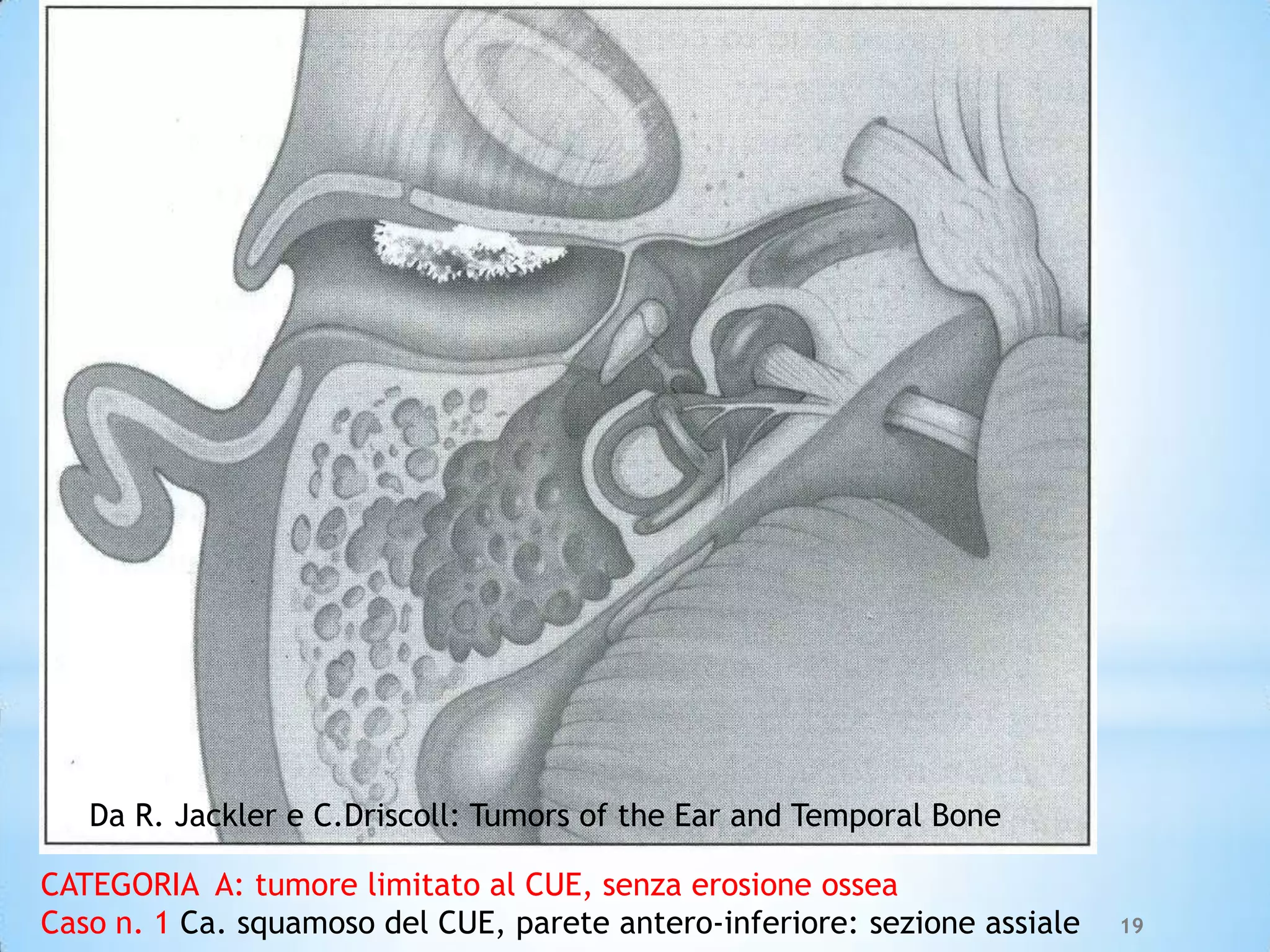 Neoplasie dell’orecchio - parte seconda | PPTX