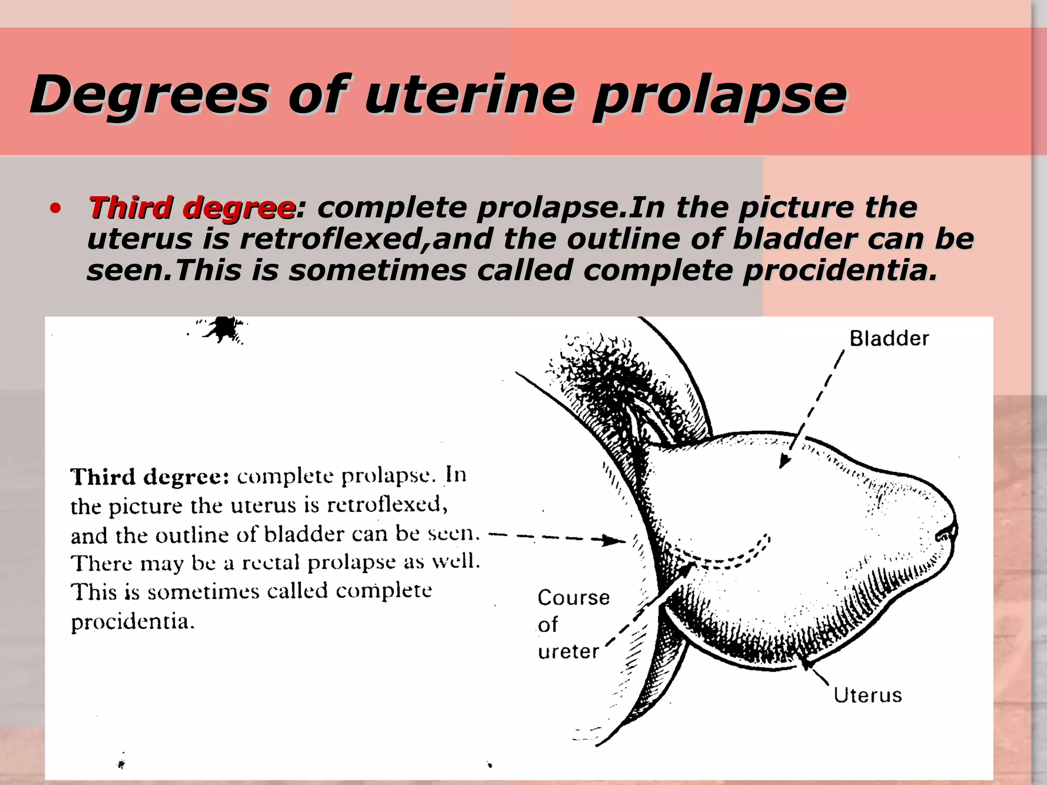 Uterine Prolapse | PPT