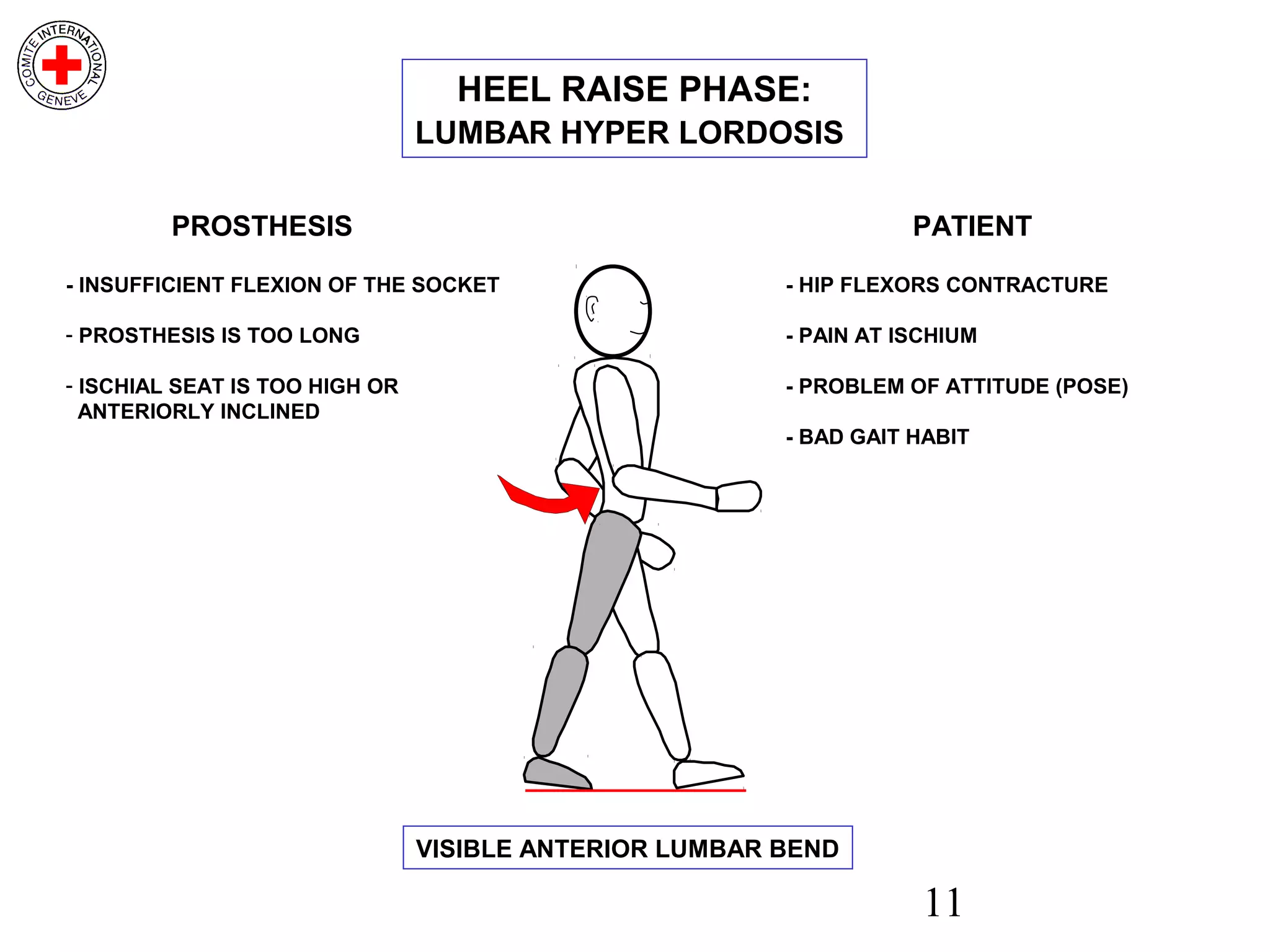 Transfemoral Gait Deviations | PPT
