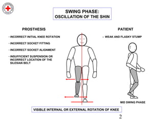 Transfemoral Gait Deviations | PPT