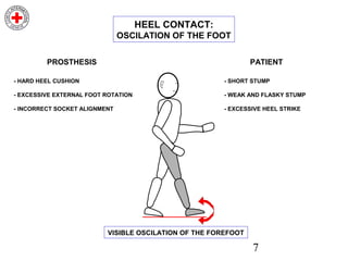 Transfemoral Gait Deviations | PPT