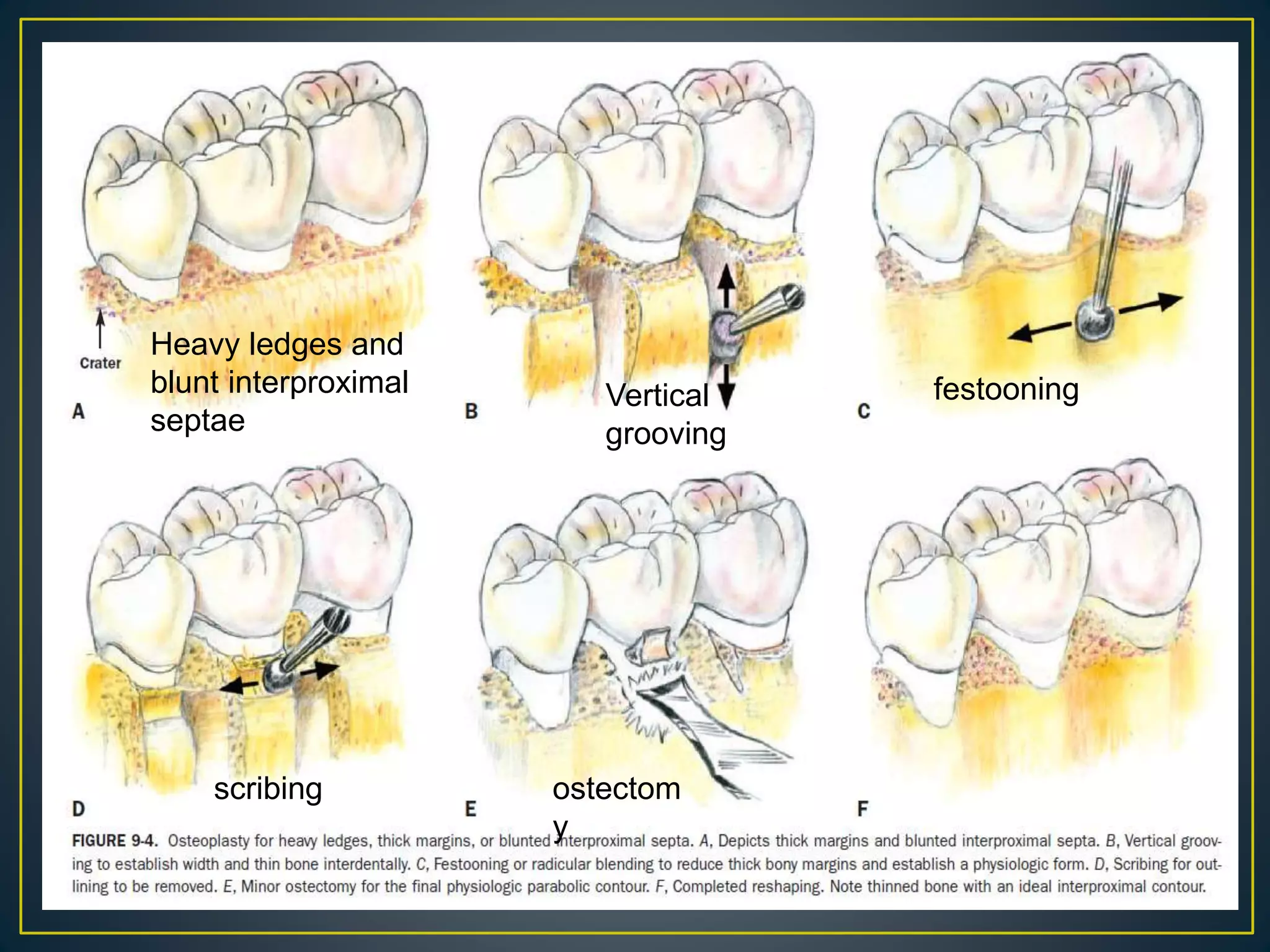 Resective osseous surgery | PPTX