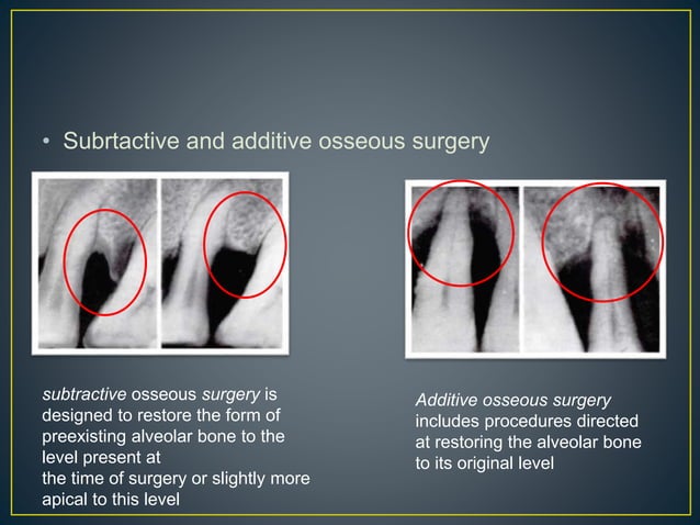 Resective osseous surgery | PPTX | Bone and Joint Conditions | Diseases ...