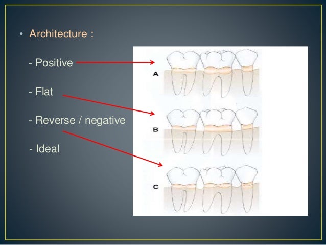 Resective osseous surgery