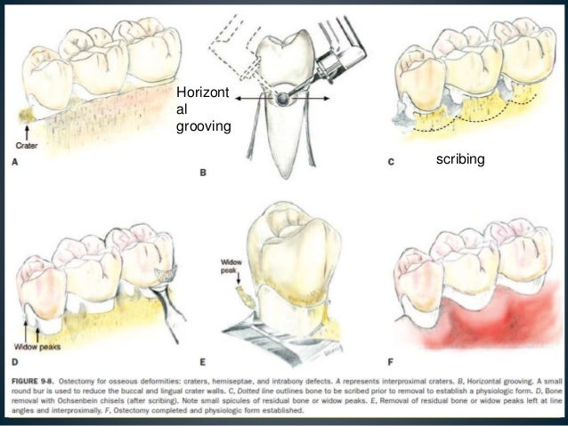 Resective osseous surgery
