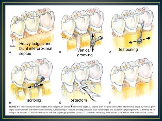 Resective osseous surgery