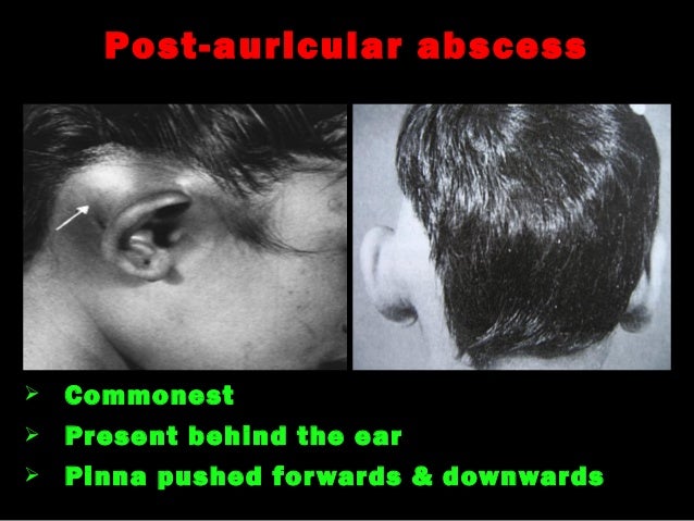 13. acute suppurative otitis media kk