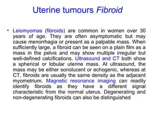 Cancer of the Female Genital Tract | PPT