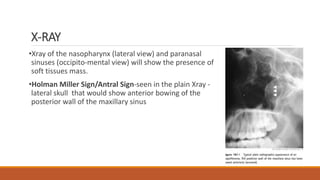 JUVENILE NASOPHARYNGEAL ANGIOFIBROMA | PPTX