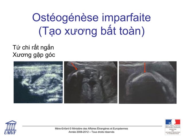 13. Sieu am loan san sun xuong, GS Michel Collet | PDF