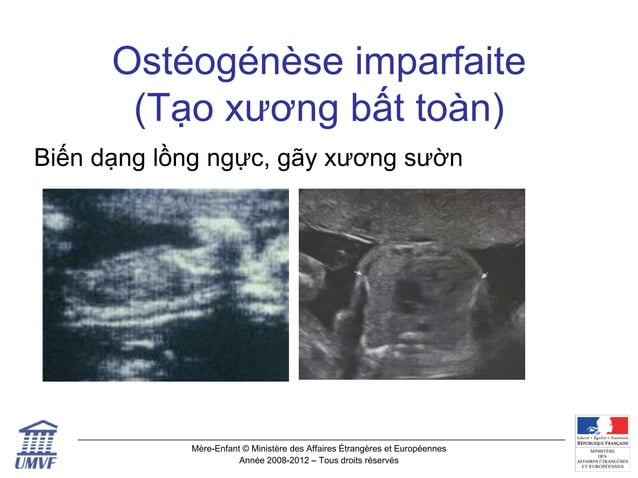 13. Sieu am loan san sun xuong, GS Michel Collet | PDF