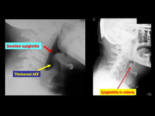 Acute and chronic laryngeal inflammations | PPT