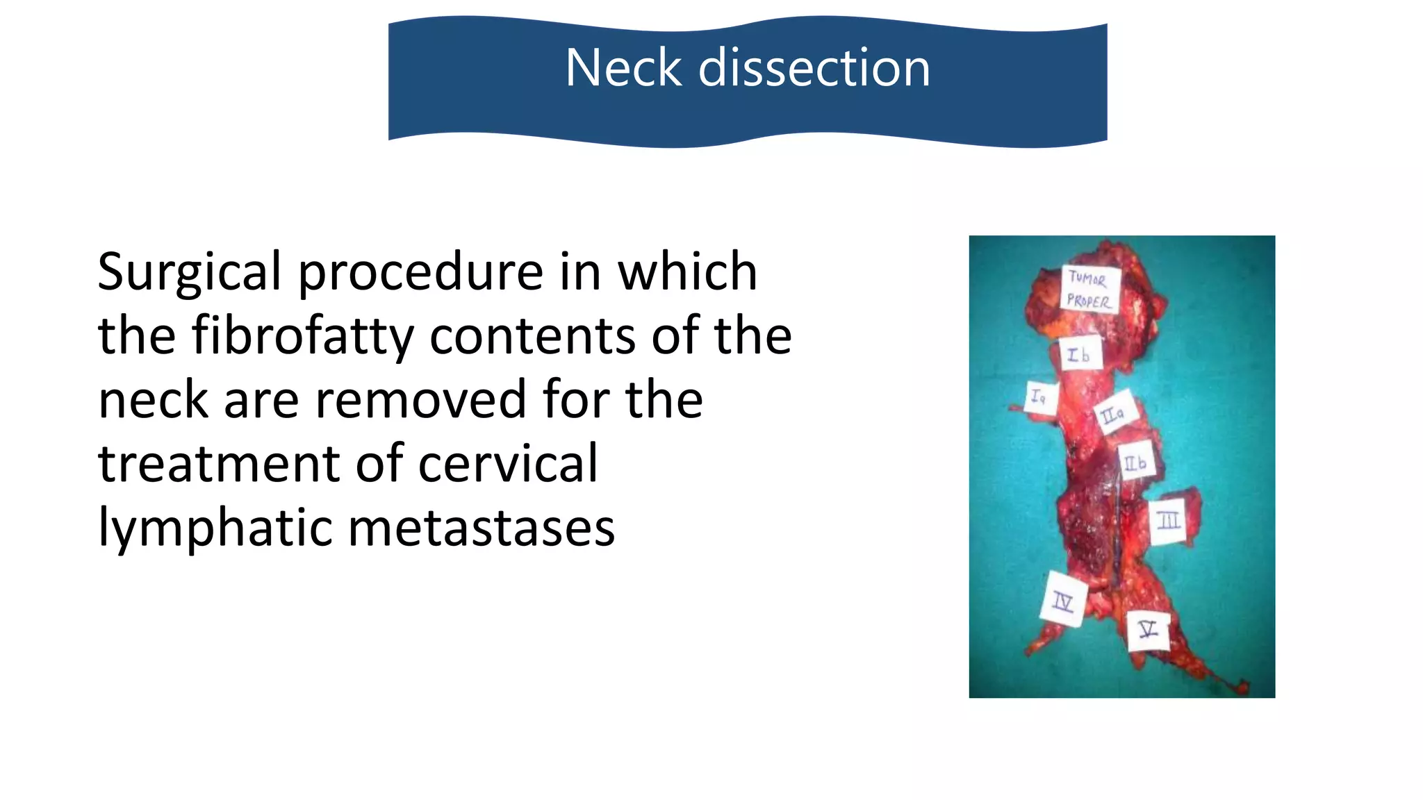 13. neck dissection - Meghali | PPTX