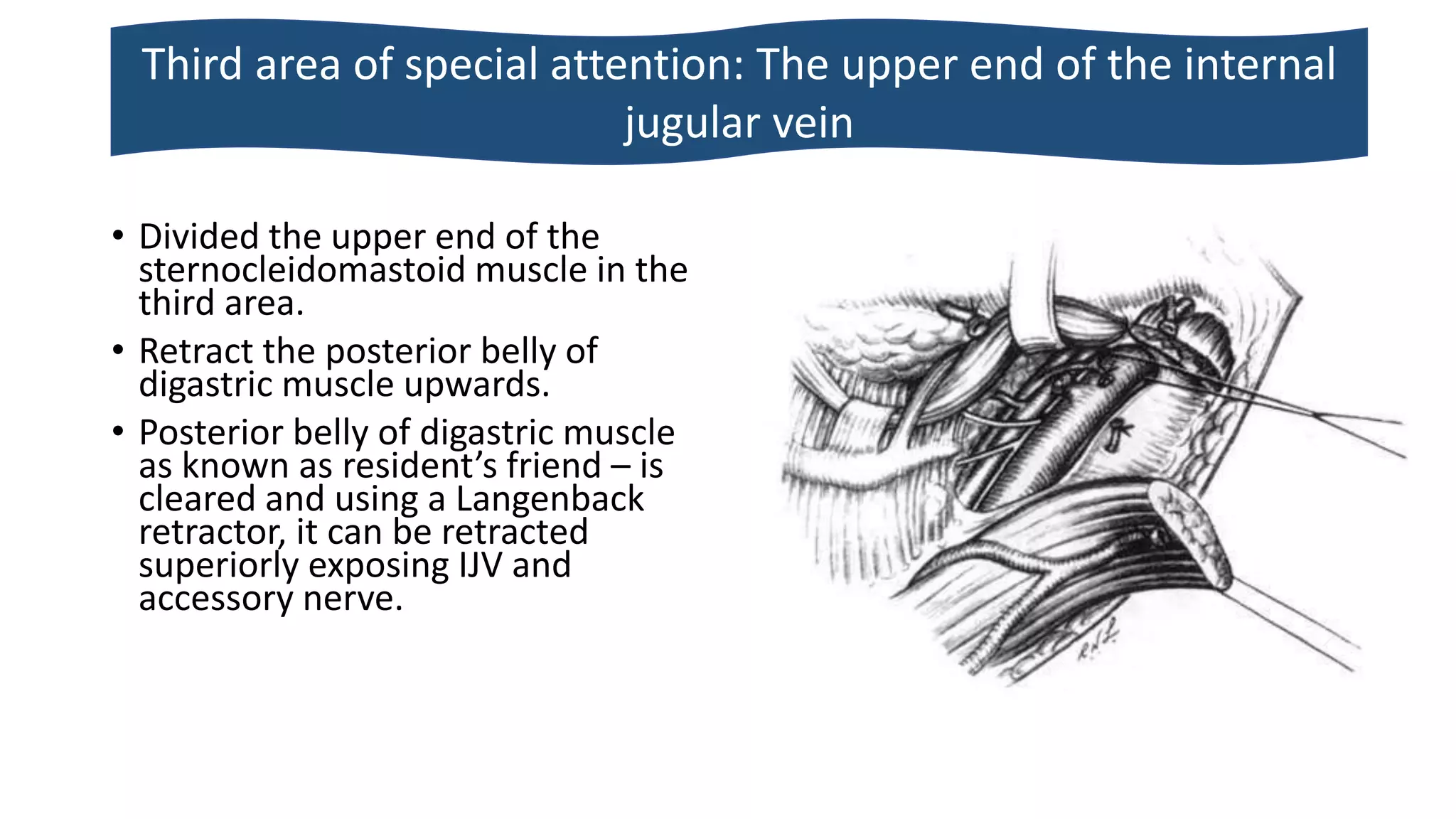 13. neck dissection - Meghali | PPTX