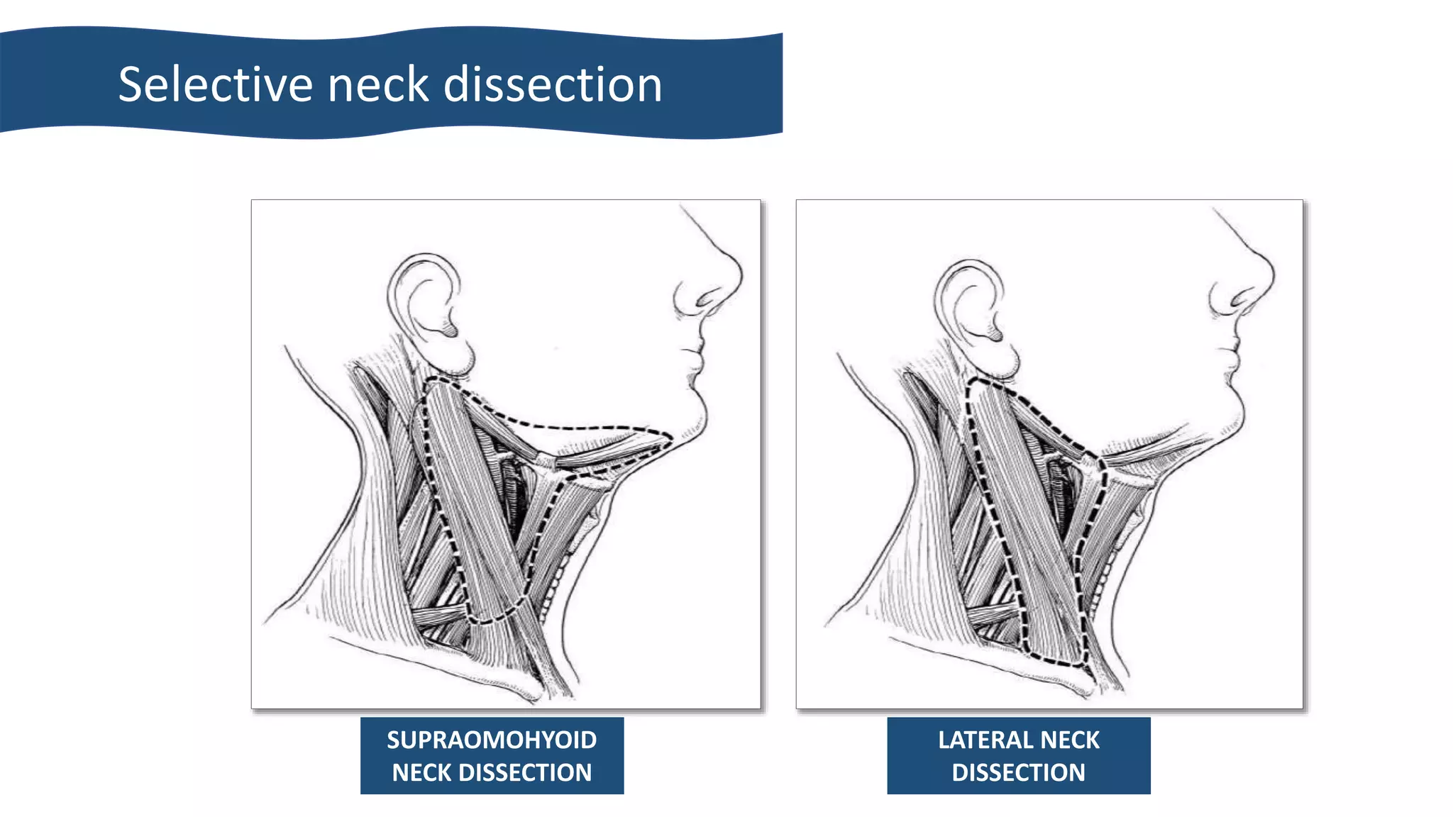 13. neck dissection - Meghali | PPTX