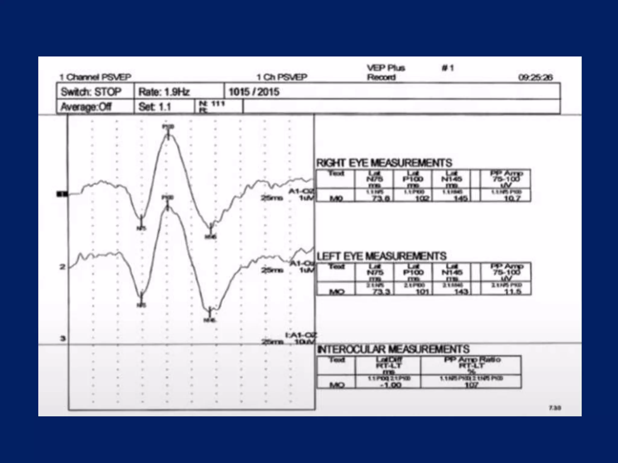 VISUAL EVOKED POTENTIAL | PPT