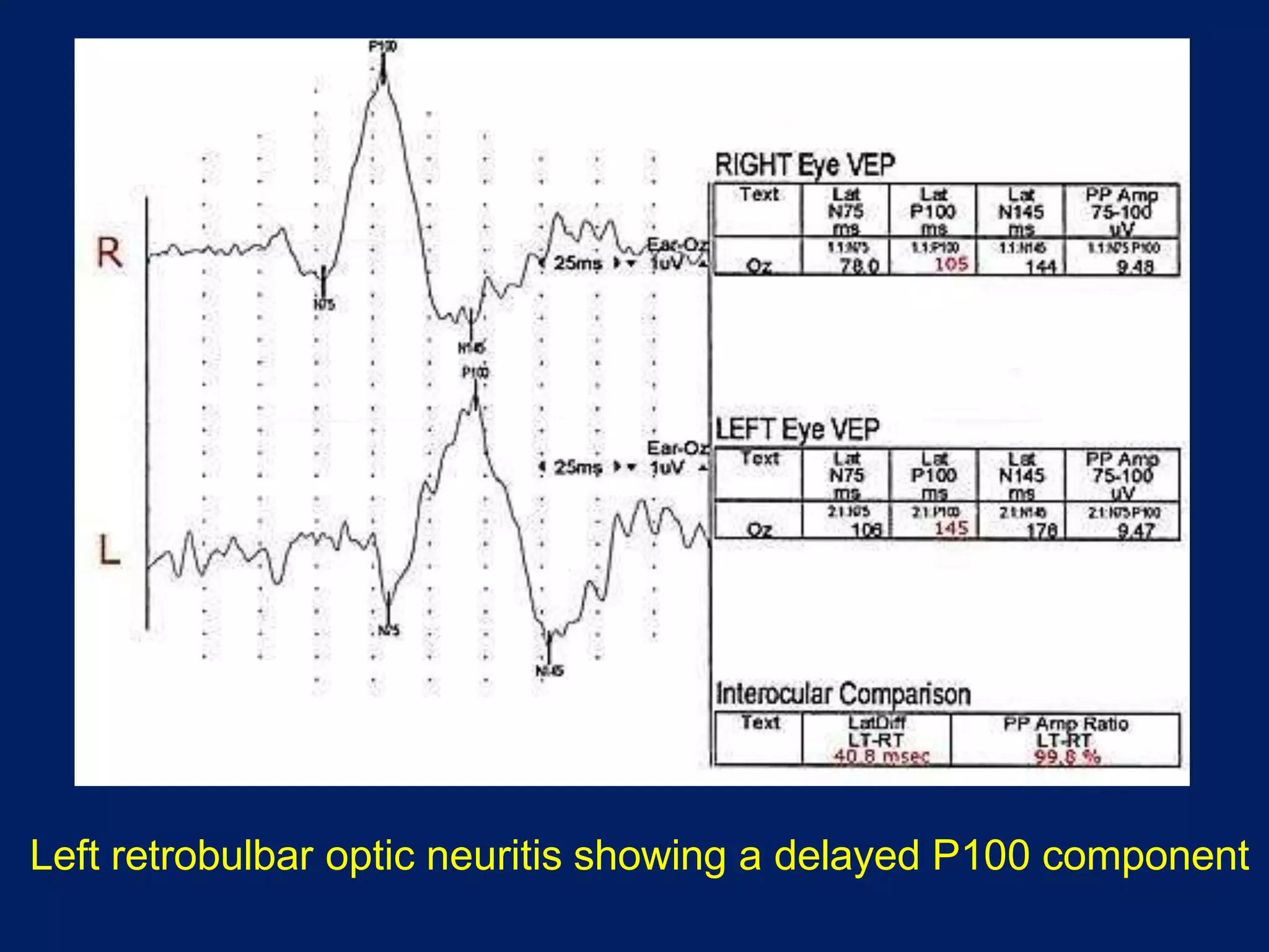 VISUAL EVOKED POTENTIAL | PPT