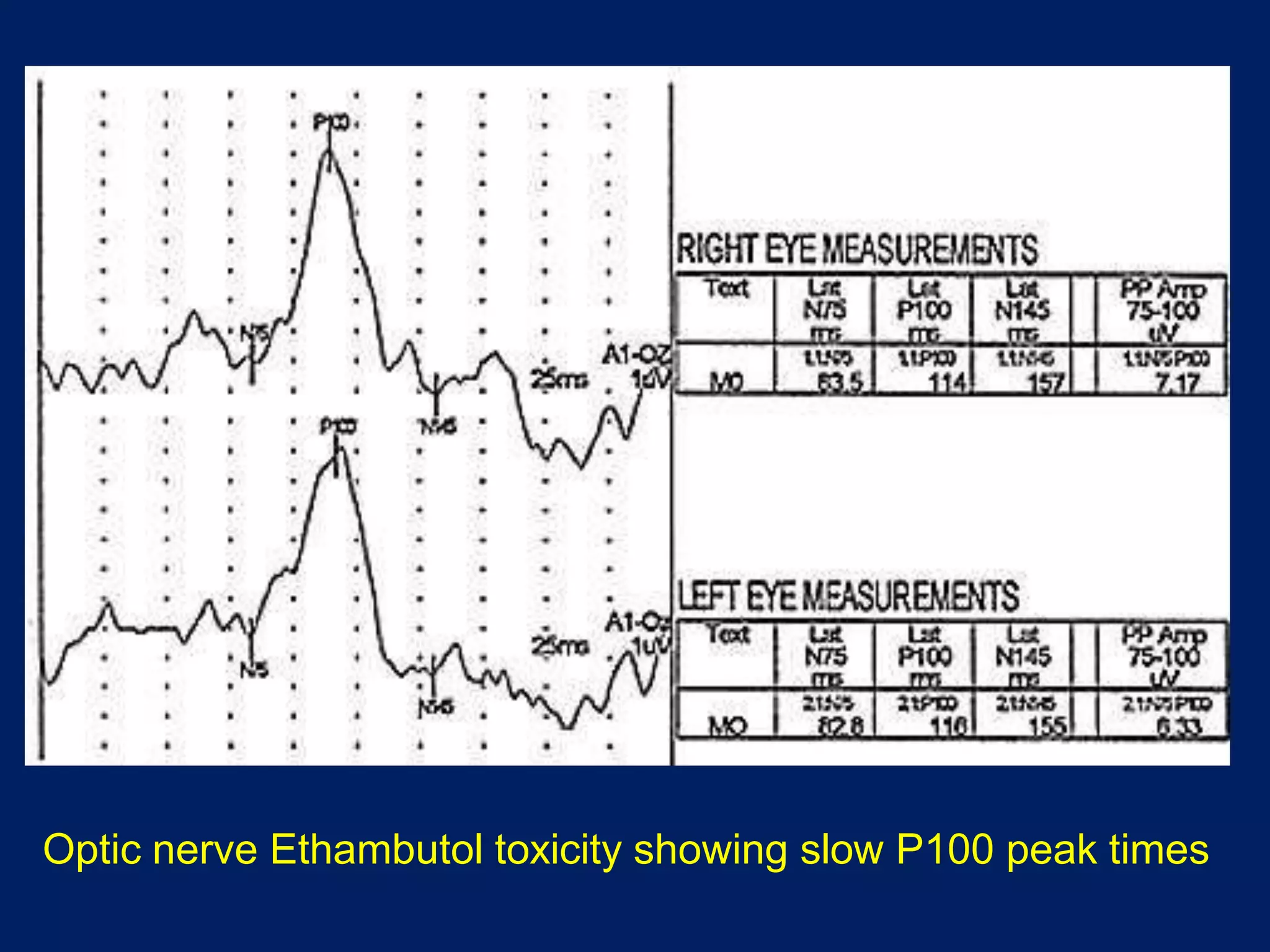 VISUAL EVOKED POTENTIAL | PPT
