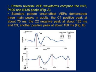 VISUAL EVOKED POTENTIAL | PPT