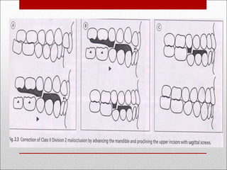 TWIN BLOCK APPLIANCE THERAPY | PPT