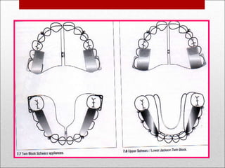 TWIN BLOCK APPLIANCE THERAPY | PPT