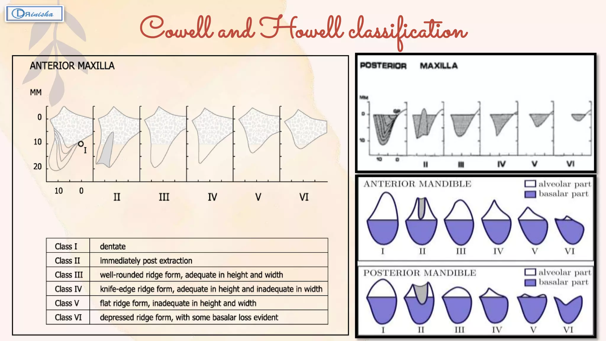 Ridge Split Techniques.pptx