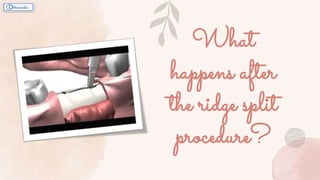 Ridge Split Techniques.pptx