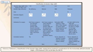 Ridge Split Techniques.pptx