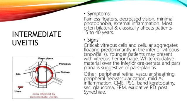 13. Uveitis.pptx