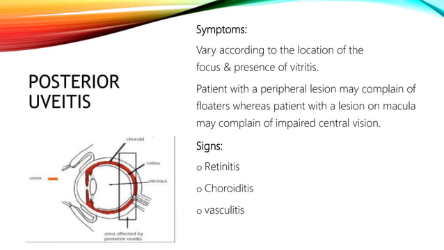 13. Uveitis.pptx