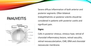 13. Uveitis.pptx