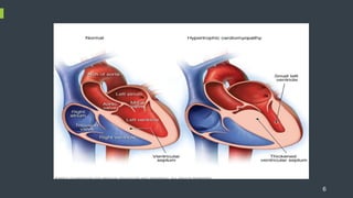 13. Cardiomyopathy.pptx