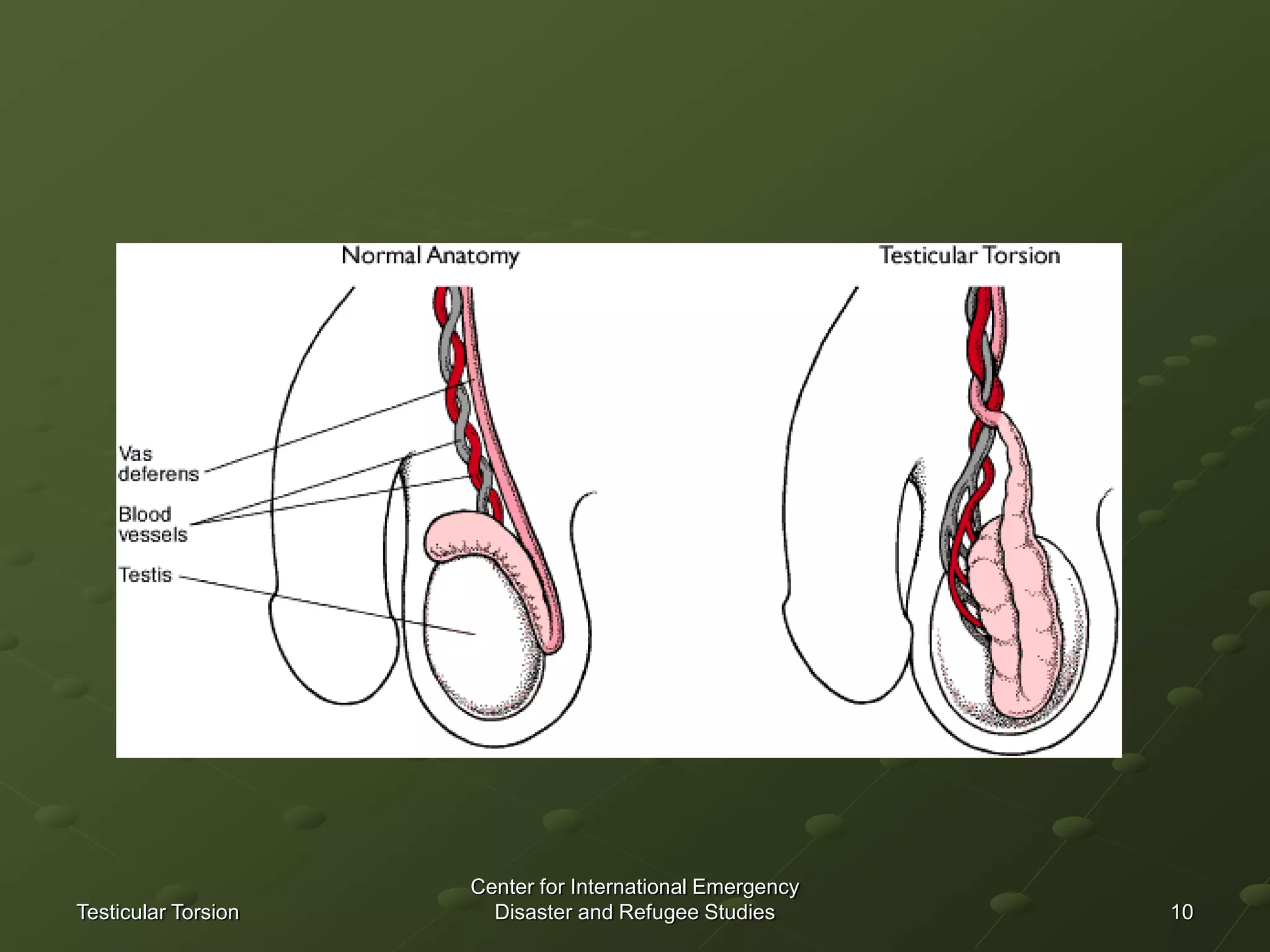 13 2 Testicular Torsion 1 Lecture Tz Ppt Free Download