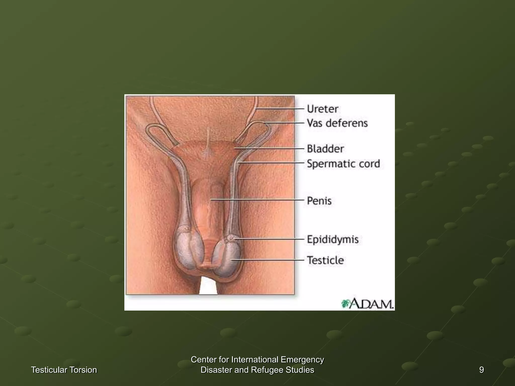 13 2 Testicular Torsion 1 Lecture Tz Ppt Free Download