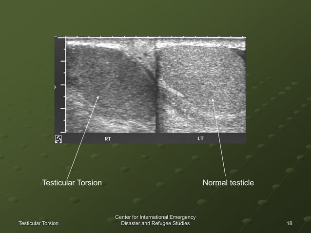 13 2 Testicular Torsion 1 Lecture Tz Ppt Free Download