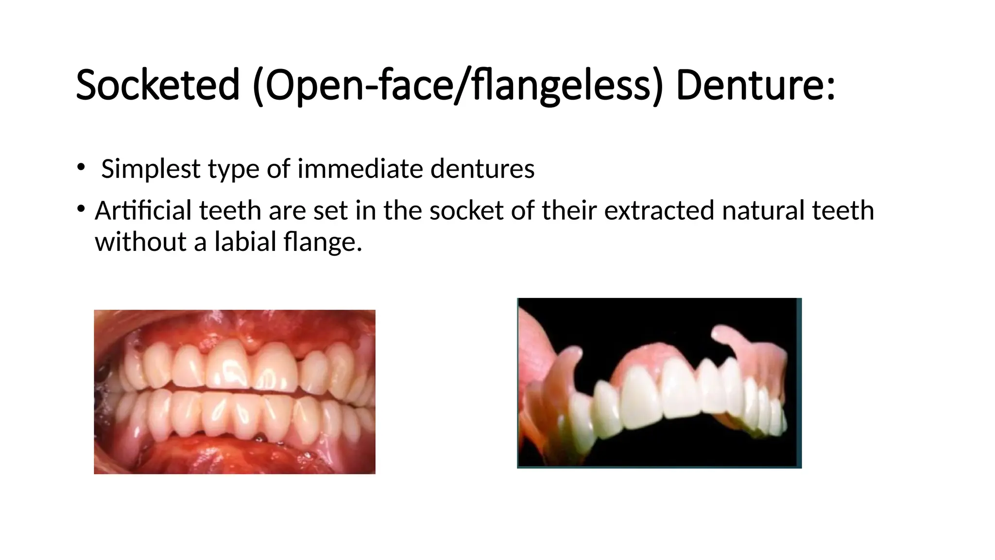13. IMMEDIATEhhhhhhhhhhhhhh DENTURE.pptx