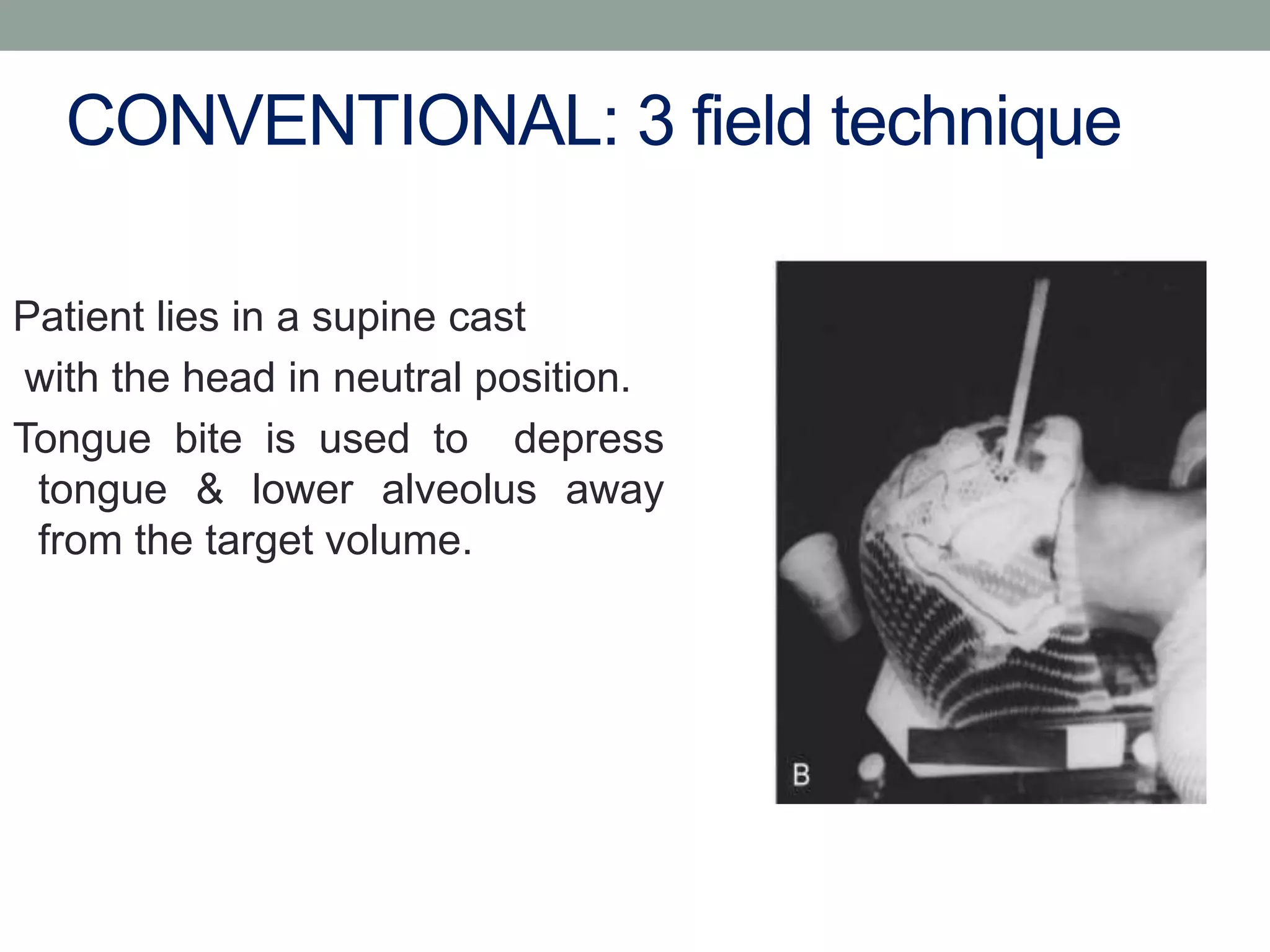 Ca Maxilla - Radiation Therapy | PPTX | Ear, Nose and Throat Conditions ...