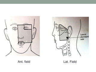 Ca Maxilla - Radiation Therapy | PPTX